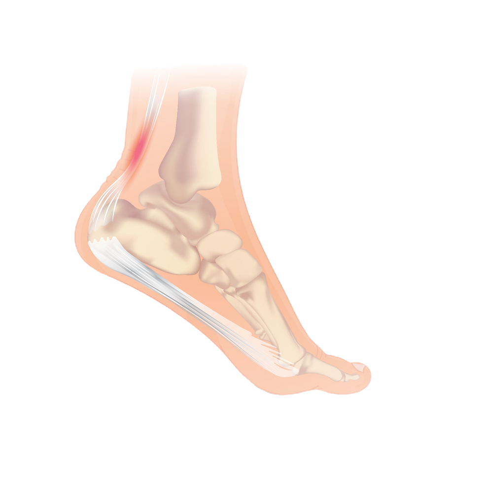 Achilles Tendinopathy